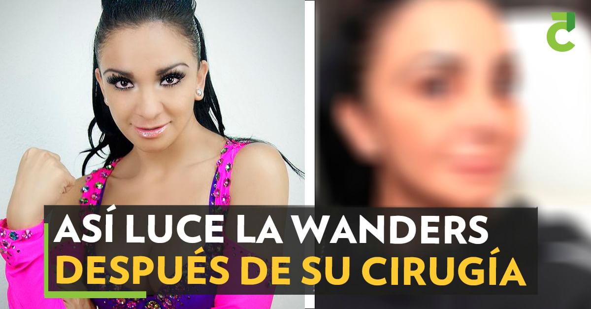 Así luce la nueva nariz de La Wanders Lover ¡tras su tercera cirugía!