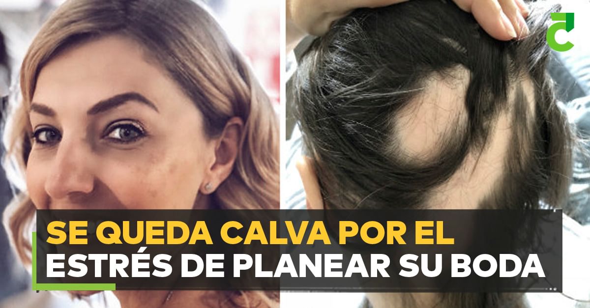 Se queda calva por el estrés de planear su boda