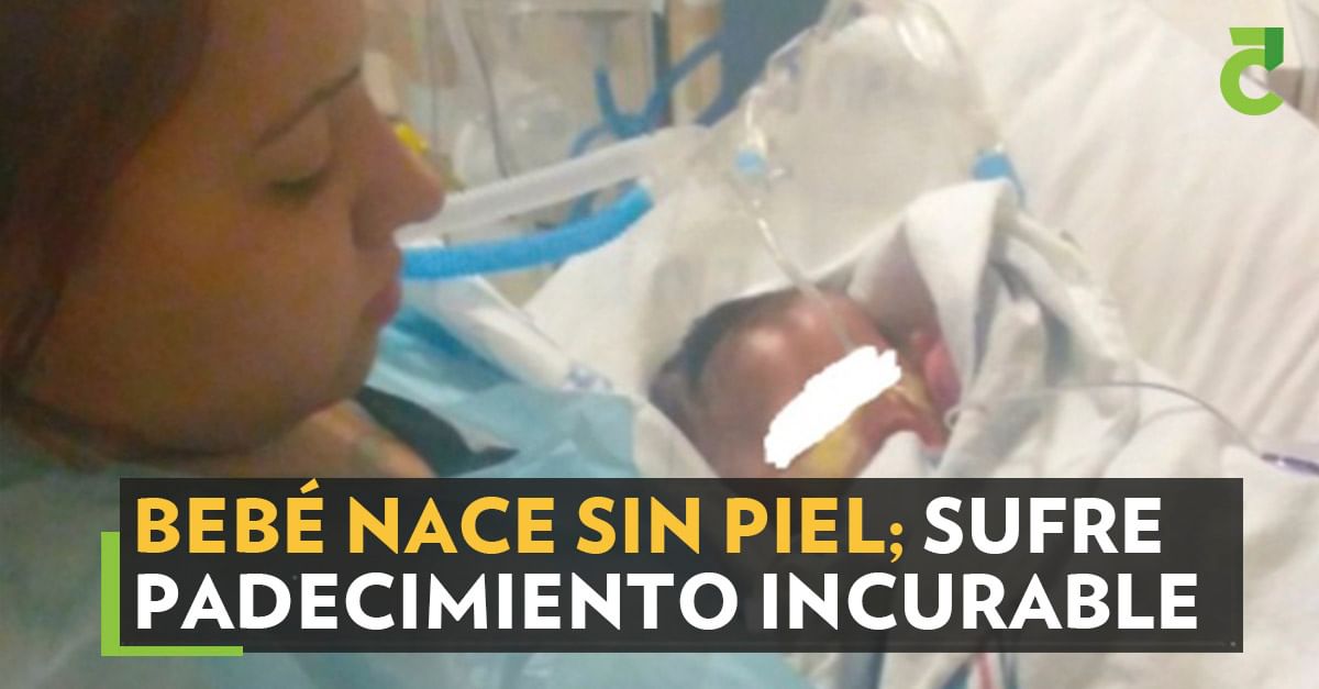 Bebé nace sin piel; sufre padecimiento incurable