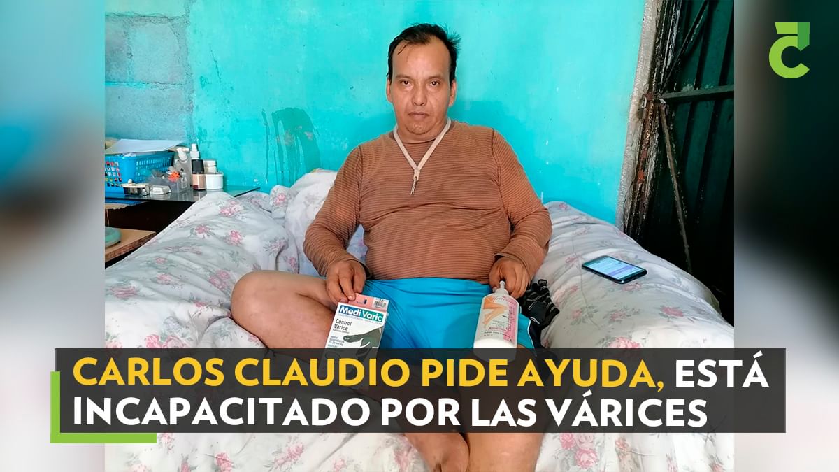 Carlos Claudio pide ayuda, está incapacitado por las várices