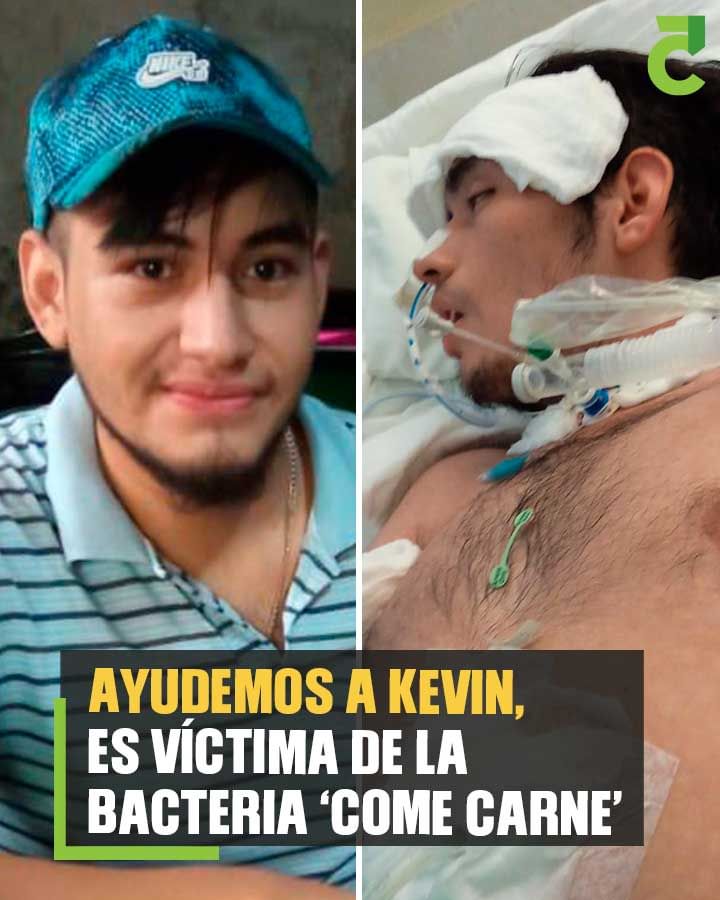 Ayudemos a Kevin, es víctima de la bacteria ‘come carne’