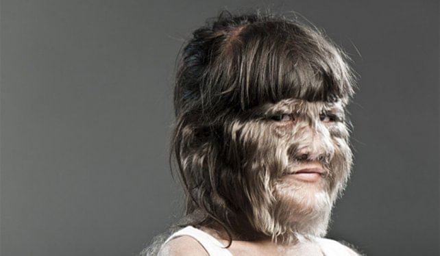 La mujer más velluda se afeita para casarse