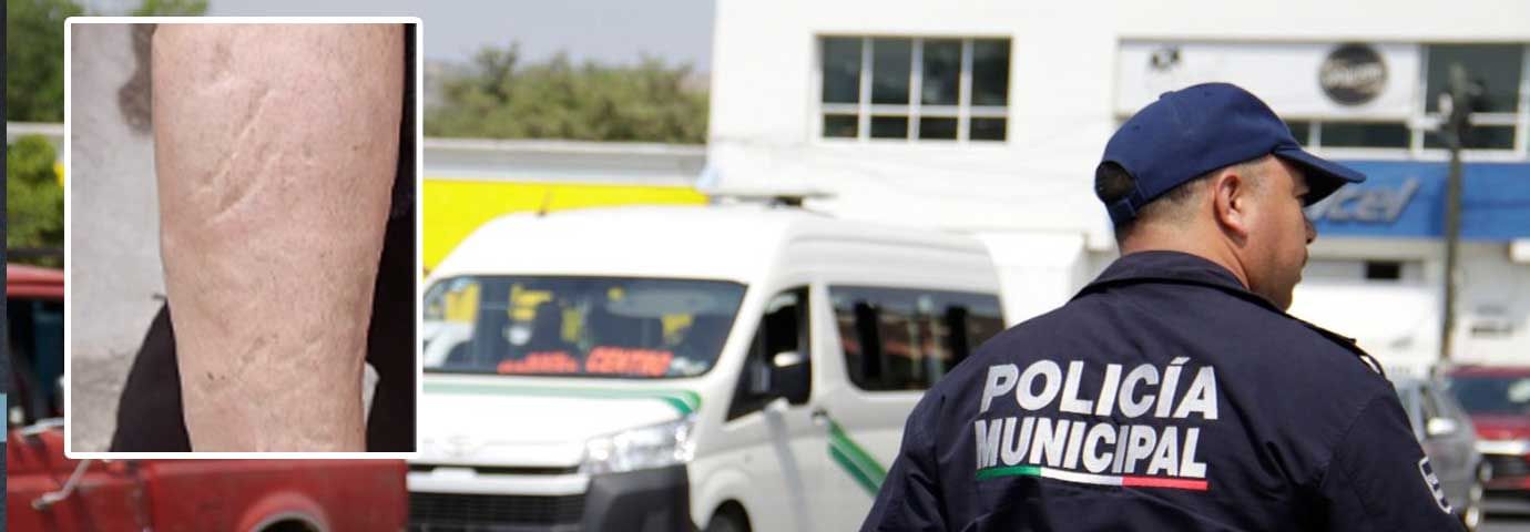 “Adiós Guapa” arrojan ácido a madre de familia