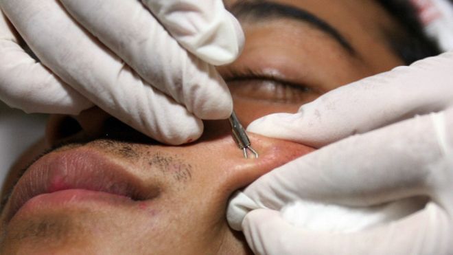 Reventar granos, la nueva sensación de internet